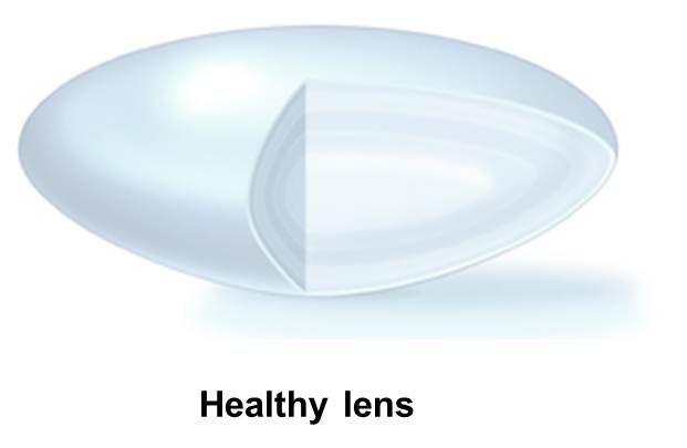 Cataract – Eye Physicians of Washington