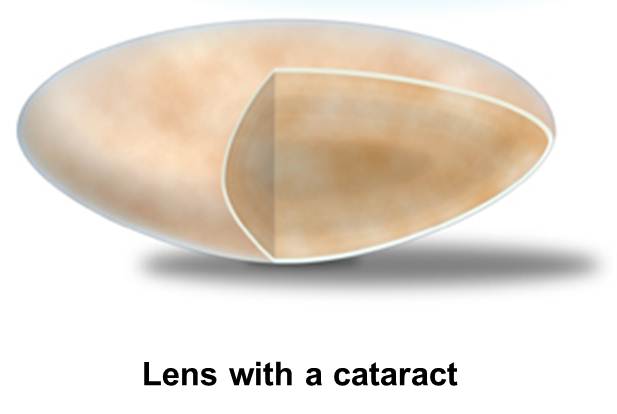 Cataract – Eye Physicians of Washington